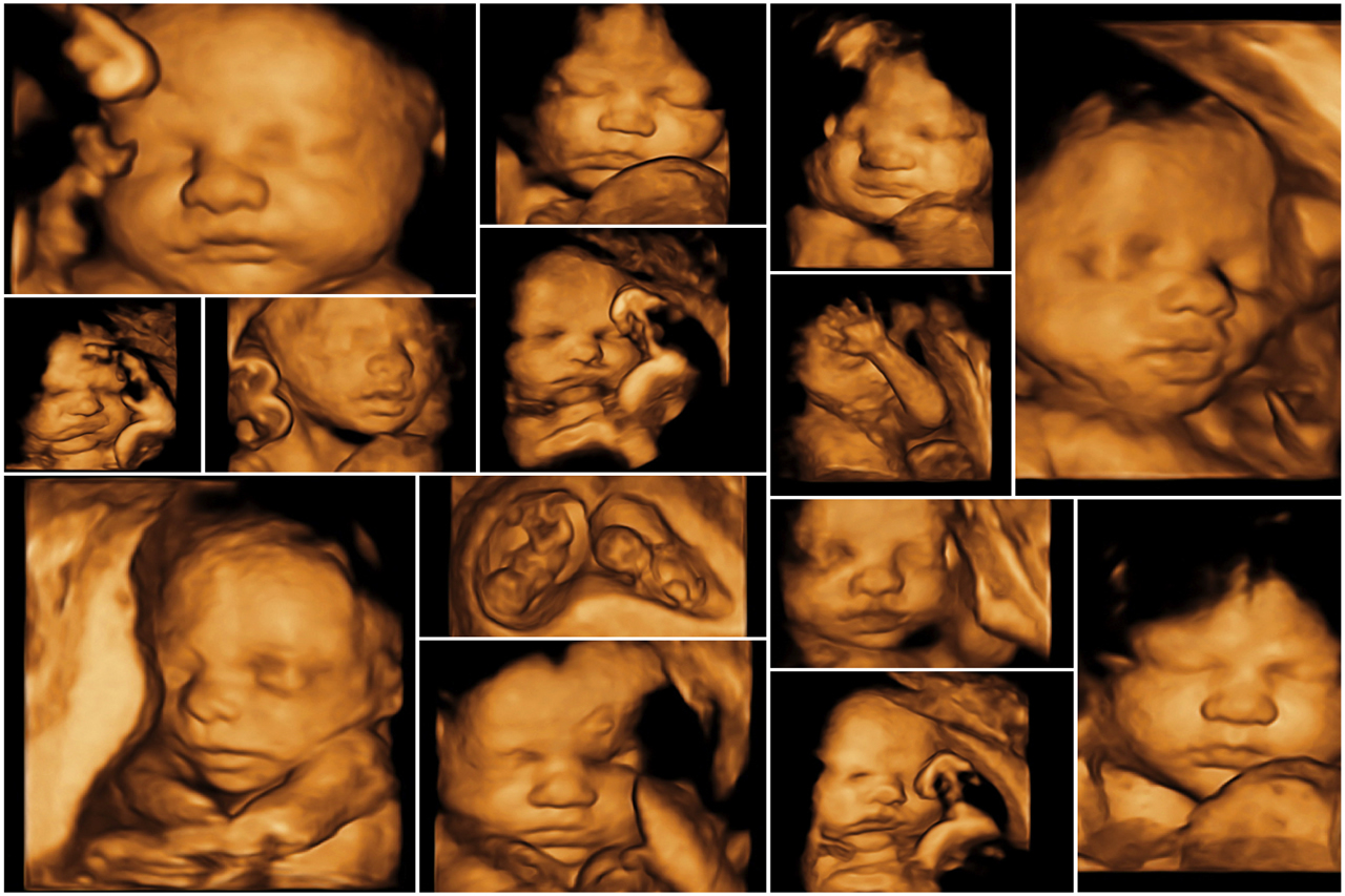 Ecografía 3D a 5D recursos para un mejor diagnóstico - Maternofetal